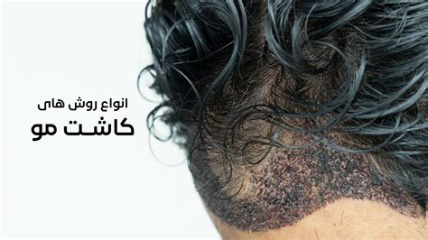 انواع روش های کاشت مو بررسی بهترین روش های کاشت مو دانشنامه پرشین دکتر