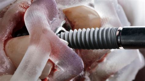 Premium Photo Dental Implant During Installation Through A Surgical