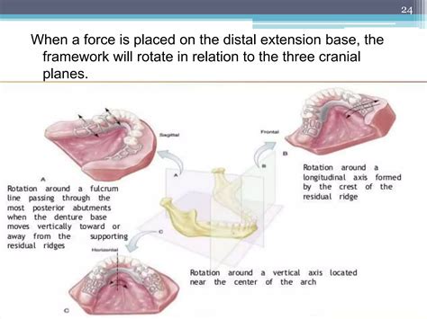 Principles Of Rpd Design According To Kennedy Classification Pptx