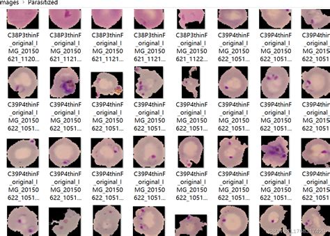 疟疾细胞感染分类数据集27560张2类别 疟疾 数据集 csdn博客