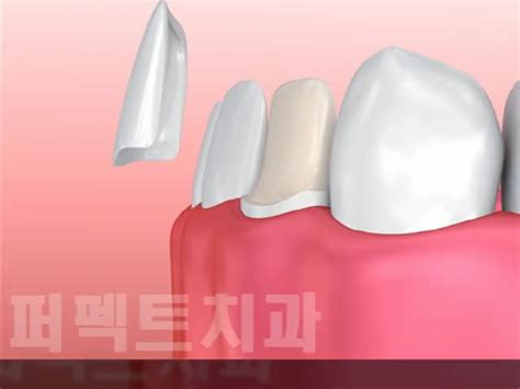 충치치료 재료 고르는 법 네이버 블로그