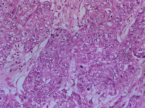 Atlas Of Breast Cancer Early Detection