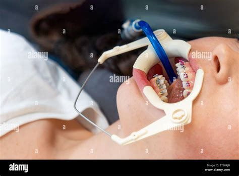 Close Up Top View Of Womans Mouth Wearing Ligature Braces Alignment And Correction Of Bite