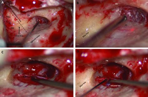 Endolymphaticmastoid Shunt Surgery Depiction Of The Download
