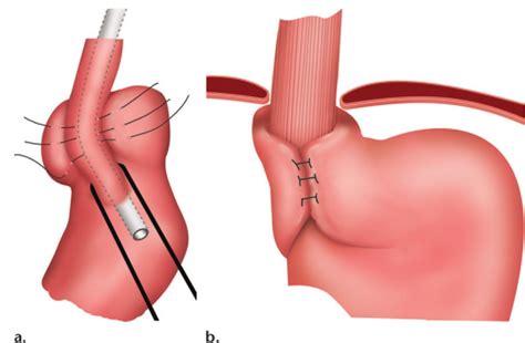 Pdf Imaging Findings Of Successful And Failed Fundoplication