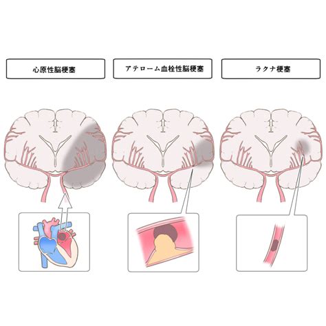 脳卒中とは 3つのタイプと違いについて分かりやすく解説 ぴんころ