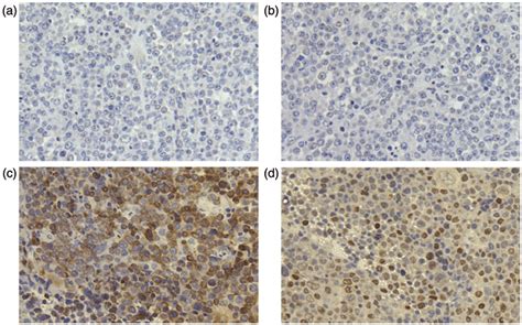 Immunohistochemical Stain For Bcl2 And Myc Protein At 200 Â Download Scientific Diagram