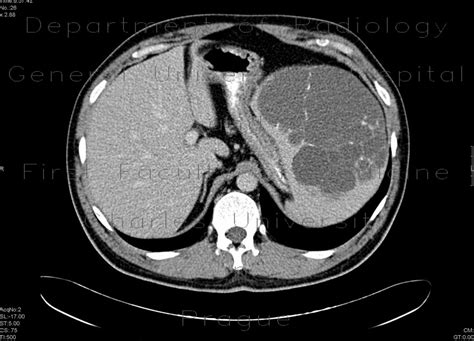 Radiology Case Splenic Cysts Congenital Epithelial