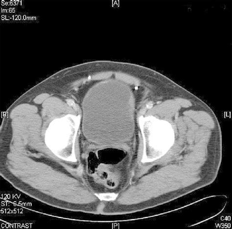 Thickening Of The Left Lateral Wall Of The Urinary Bladder Seen On The
