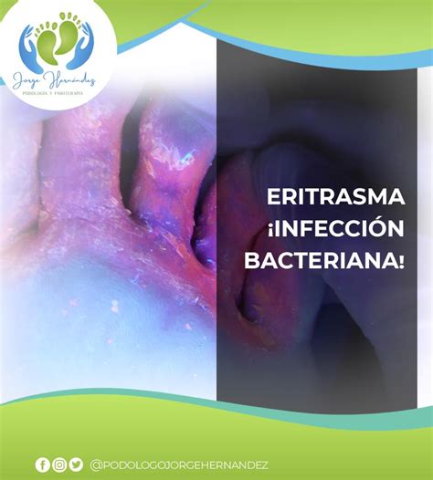 🦶 El Eritrasma Interdigital Podologia Jorge Hernandez