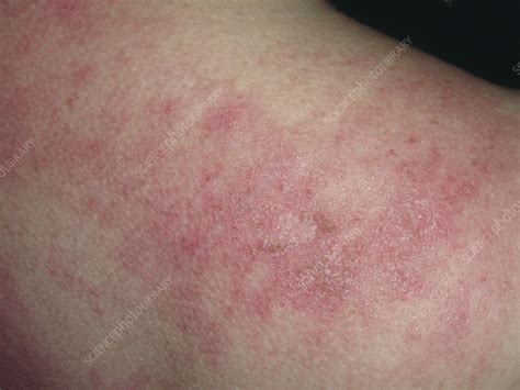 Dermatomyositis Stock Image C0575175 Science Photo Library