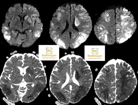 Hypoxic Ischemic Encephalopathy Radiology Case Radiogyan