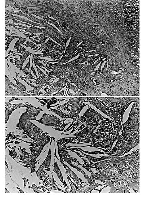 Upper Photomicrograph Demonstrating Fibrous Tissue And Cholesterol