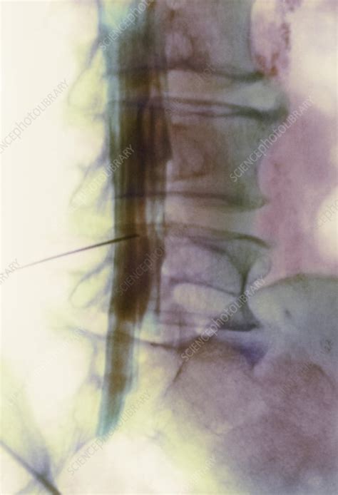 Slipped Disc Myelogram Stock Image M330 1014 Science Photo Library