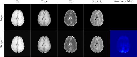 Diffusion Models For Medical Anomaly Detection