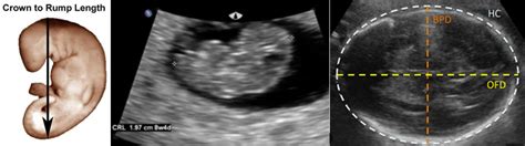 임신의 진단 메디톡