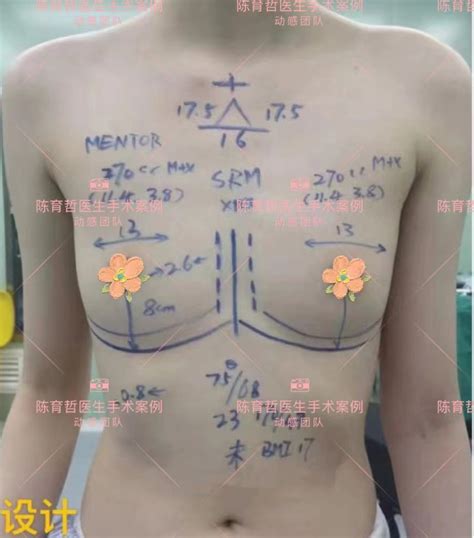 诊间日记：光面假体隆胸远期效果！陈育哲主任医师爱问健康