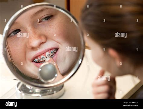 Netherlands A Girl Is Looking At Her Dental Braces Dental Braces Also Known As Braces