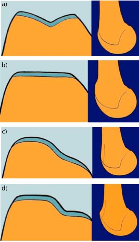 D Dejours Classification For The Trochlear Dysplasia Type A With An Download Scientific