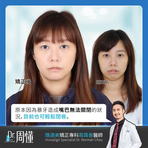 案例分享 暴牙X笑齦X三門齒 周霖晉醫師齒顎矯正專科隱適美隱形矯正