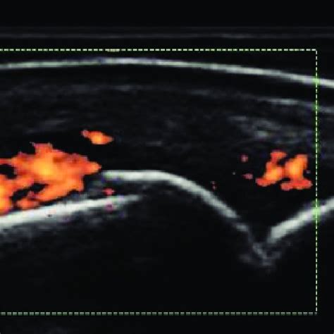 Synovitis Of The Mtp Joint 2 At Dorsal Aspect In Grey Scale Ultrasound