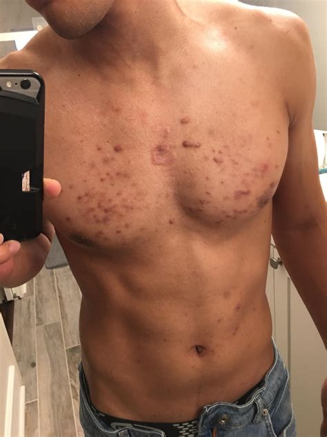 Any Advice On Chest Acne And Keloid Scars Racne