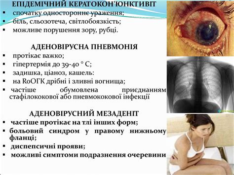 Гострі респіраторні вірусні інфекції презентация онлайн