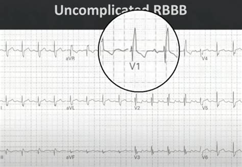17 24 Same Ecg As 17 16 And 17 23