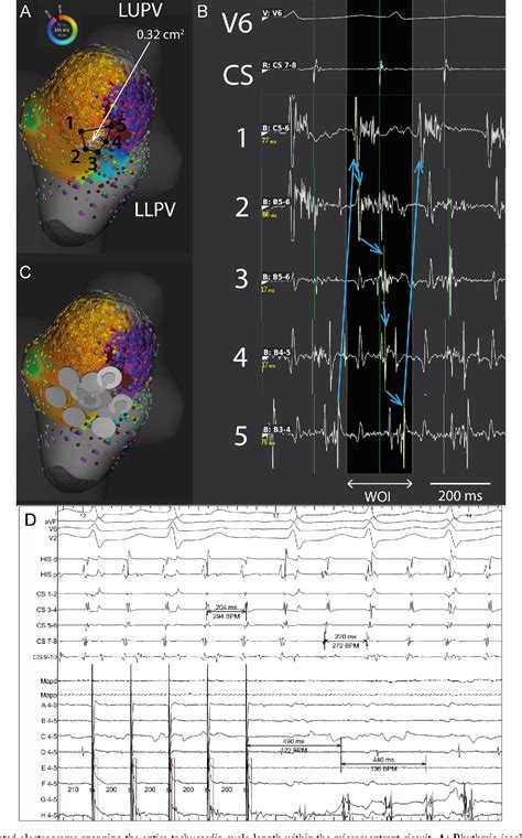 Figure 2 From Microreentrant Left Atrial Tachycardia Circuit Mapped With An Ultra High Density