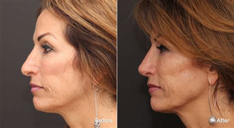 Rhinoplasty Photos Princeton Nj Patient 8877