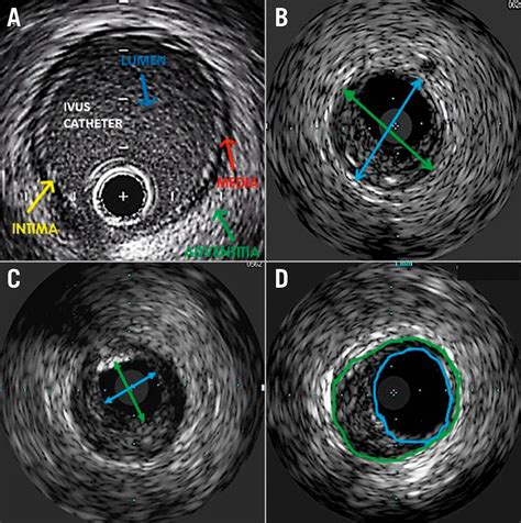 Intravascular Ultrasound Guidance For Lower Extremity Arterial And