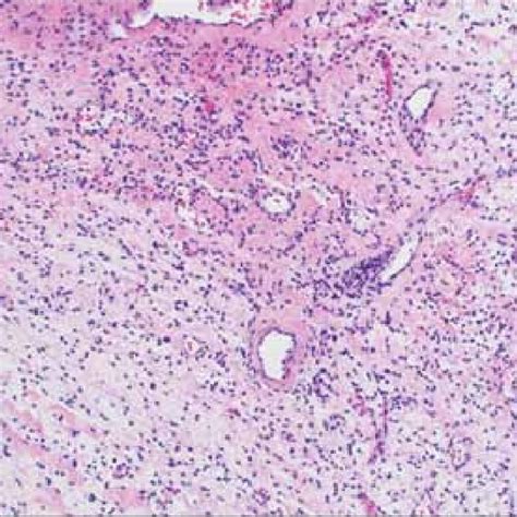 Histopathology Demonstrates Loosely Organized Bland Spindle Shaped