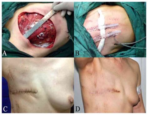 Delayed Primary Closure Of Extensive Wounds Using The Topclosure System
