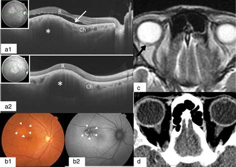 Oct Images At The First Visit Showed A Metastatic Lesion Of The Choroid Download Scientific
