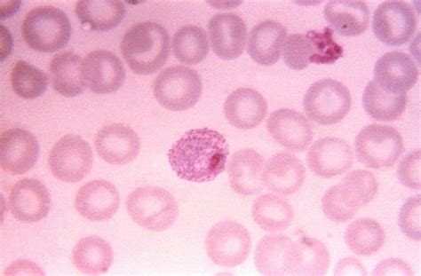 Free Picture Photo Micrograph Ring Form Plasmodium Falciparum