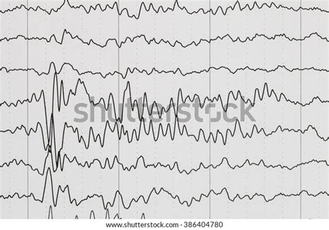 Abnormal Eeg Waves Lalartechnologies