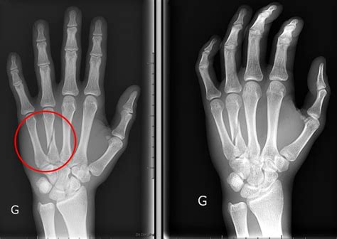 Dr Nicolas Rueff Chirurgie Orthopédique Et Traumatologie Hôpital De