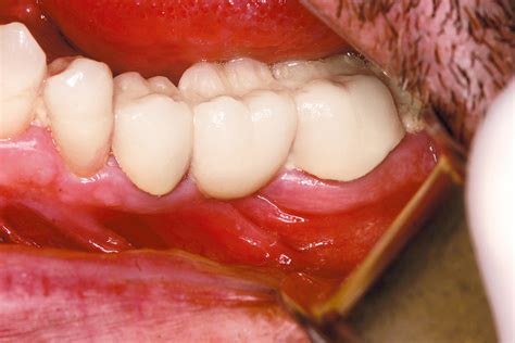 Geistlich Usa Gain Of Keratinized Tissue