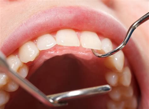 Poor Oral Health Could Raise Oral HPV Risk HuffPost
