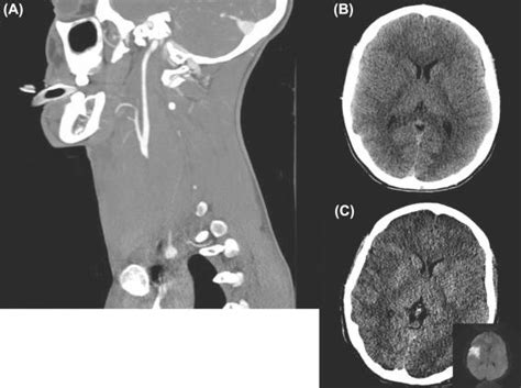 Stroke Secondary To Trauma Clinical Tree