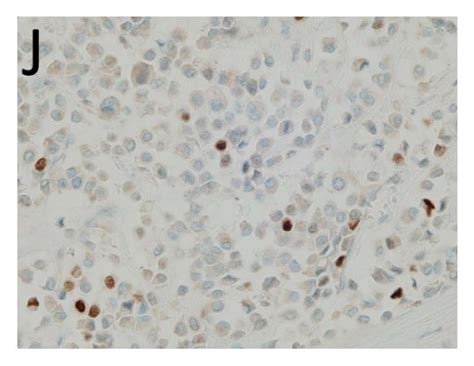 Immunohistochemical Findings A Iplc Case 3 Immunopositivity For