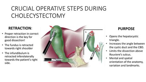 Cholecystectomy Anatomy Types Surgical Steps Errors Troubleshooting Complications And