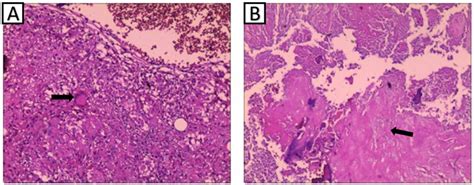 A And B Pathological Examination After Primary Surgery Figure A