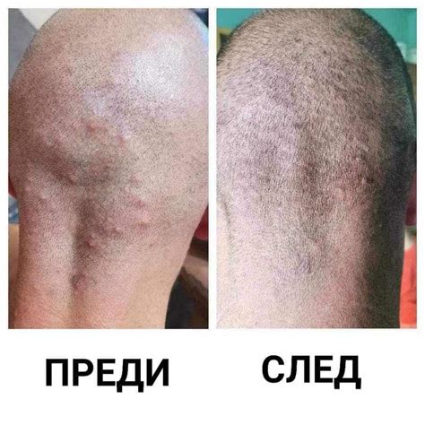 Н К Споделено от Даниела Алексиева От жегата на мъжа ми му излизат пъпки по главата и тялото