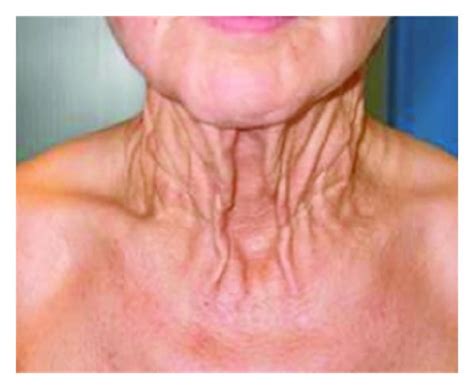 Pseudoxanthoma Elasticum Face