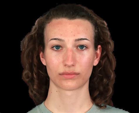 Amelia Before And After Ffs Surgery Facialteam