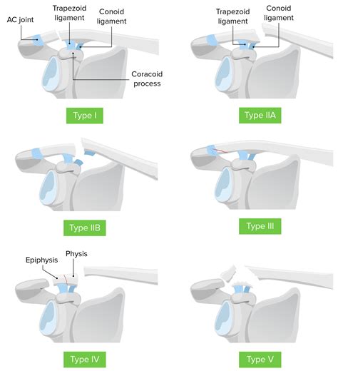 Distal Clavicle Fracture Classification