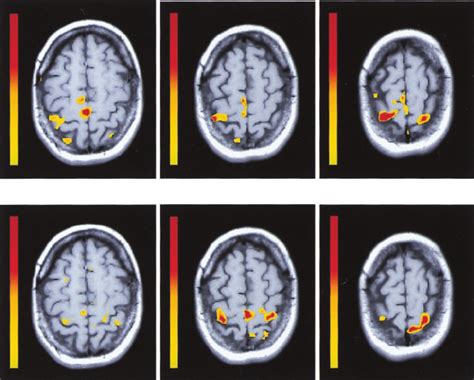 Cortical Activation Areas During Movements Of Existing Body Parts Download Scientific Diagram