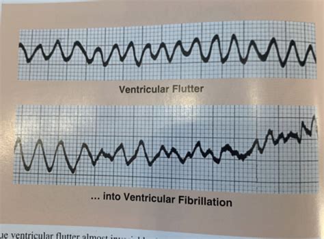 Ventricular Flutter