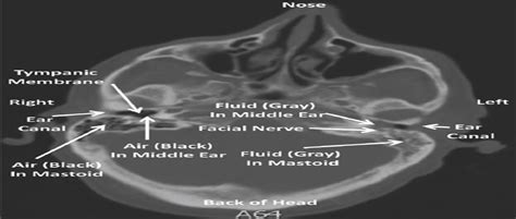 Symptom Serous Effusion The Hearing Journal